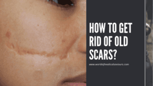 How to get rid of old scars: Top 10 Remedies