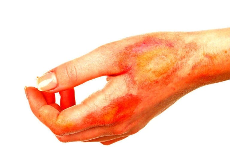 How to treat burn? [Principle of treatment] - Medical blogs for students
