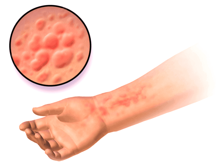 Clinical features and Causes of Hives (Urticaria) with Management