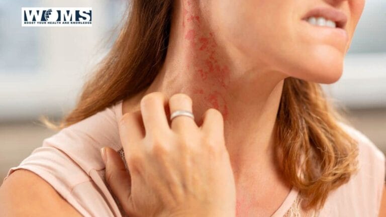 No More Amoxicillin Allergy & Rashes-Side Effects,symptoms & Treatment