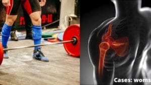 Popeye Deformity - WOMS