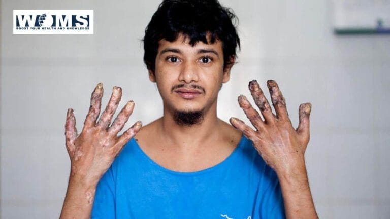 Bangladesh’s tree man’ is back to the hospital -WOMS
