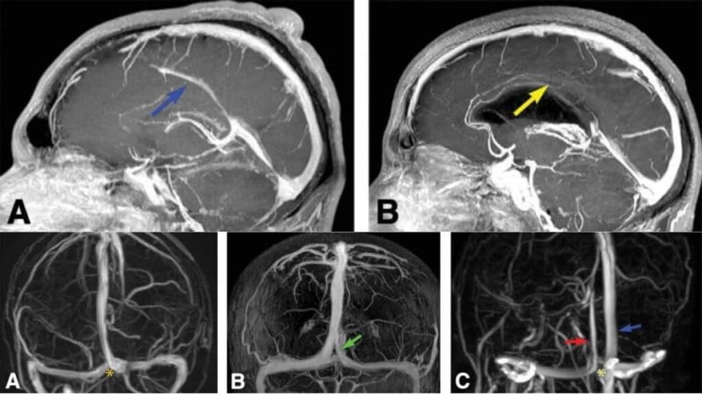 The Occipital Bone: Parts, Surface, Borders & Clinical significance