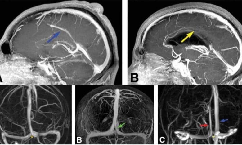 Normal as well as variant anatomy of the dural venous sinuses - WOMS