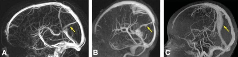 Normal as well as variant anatomy of the dural venous sinuses - WOMS