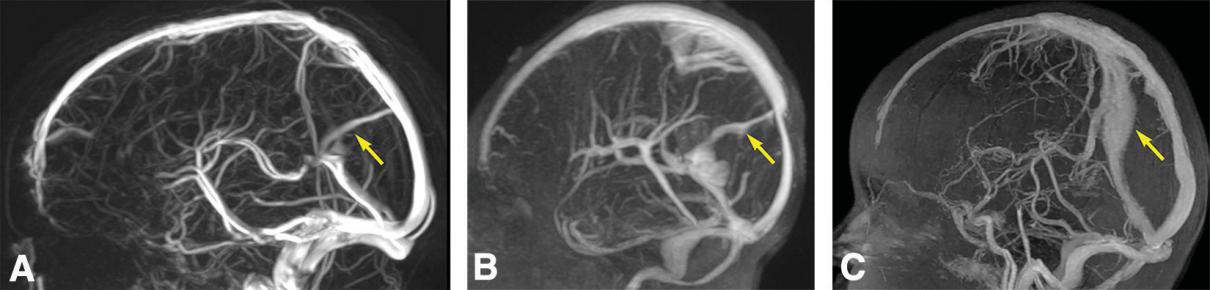 Normal as well as variant anatomy of the dural venous sinuses - WOMS
