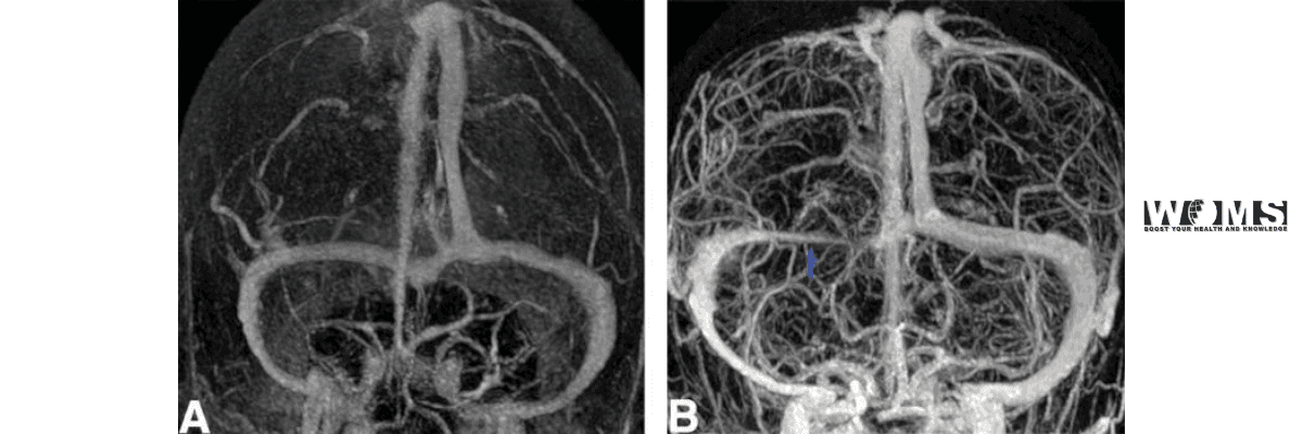 Normal as well as variant anatomy of the dural venous sinuses - WOMS