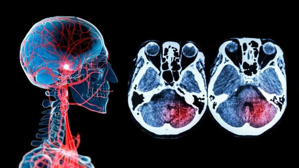 Everything You Need To Know About Getting A Stroke And Tips To Avoid It ...