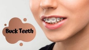 Overbite or Buck Teeth - WOMS