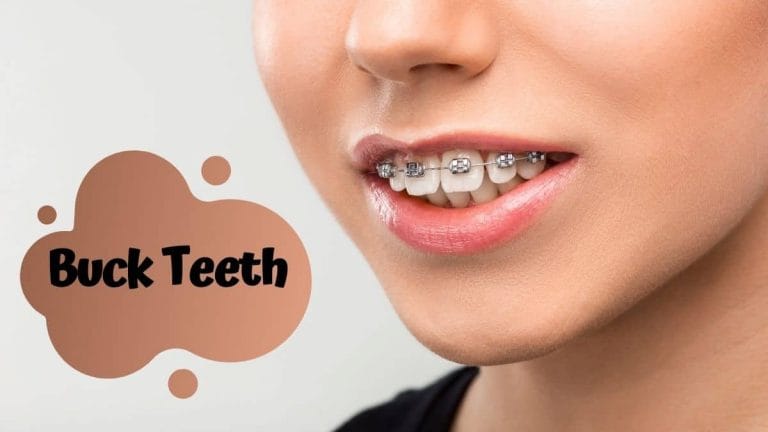 Overbite or Buck Teeth - WOMS