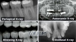 Baby Teeth X-ray : Is it safe or harmful for baby? - WOMS