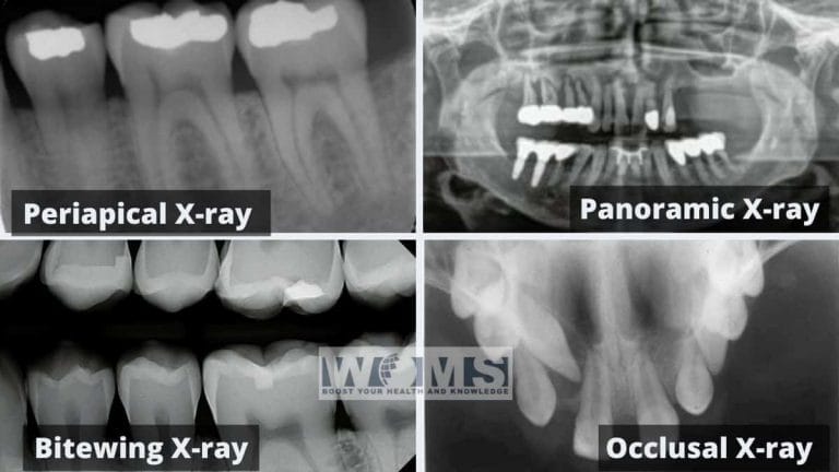 Baby Teeth X-ray : Is it safe or harmful for baby? - WOMS