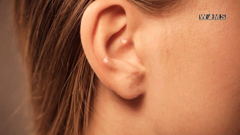 Pimple in Ear: Causes And Prevention - WOMS