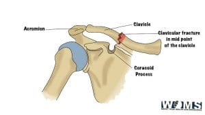 3 Types of Clavicle Fracture: Symptoms, & Treatment - WOMS
