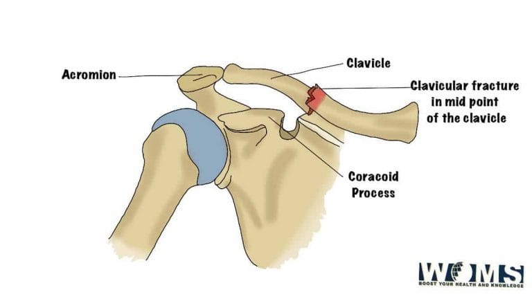 3 Types of Clavicle Fracture: Symptoms, & Treatment - WOMS