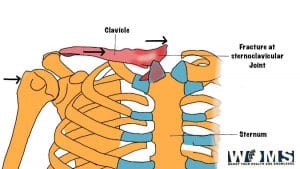 3 Types of Clavicle Fracture: Symptoms, & Treatment - WOMS