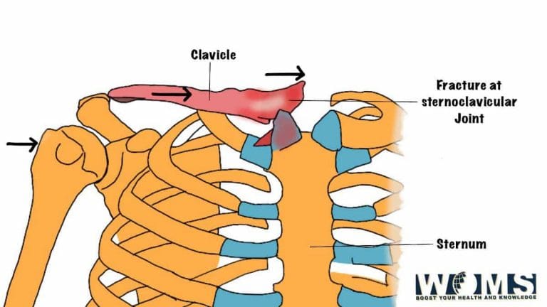3 Types of Clavicle Fracture: Symptoms, & Treatment - WOMS