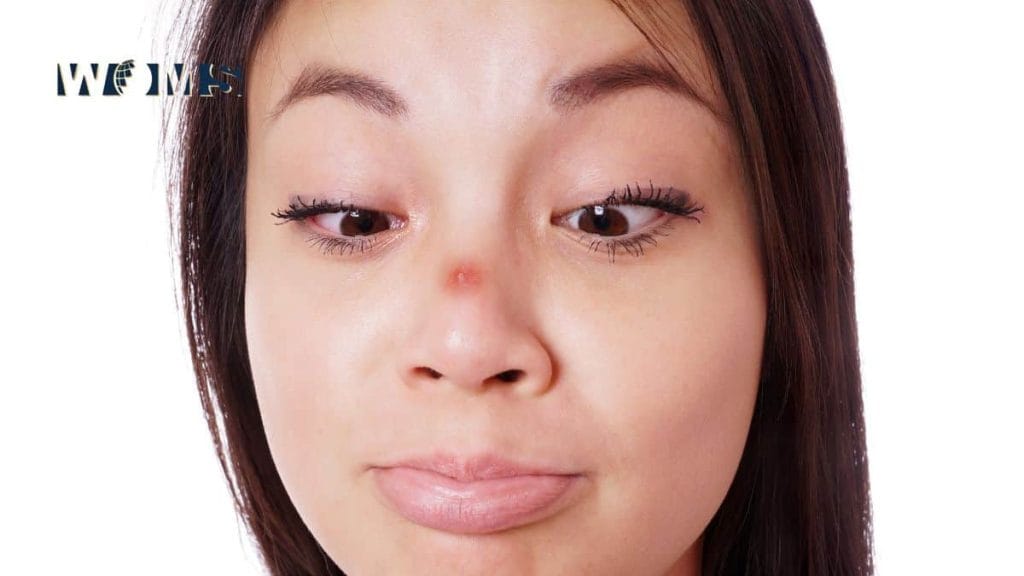 Understanding and Managing Pimple Nose: Types, Causes, and Treatment - WOMS