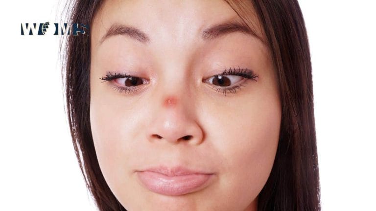 Understanding and Managing Pimple Nose: Types, Causes, and Treatment - WOMS