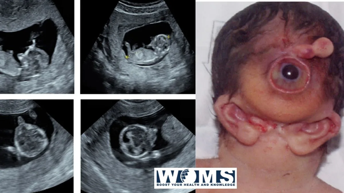 Otocephaly: A Rare Syndrome with Multiple Malformations - WOMS