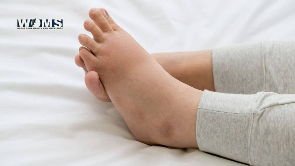 Understanding Leg Swelling - WOMS